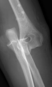 Luxación de Codo - HYCEM