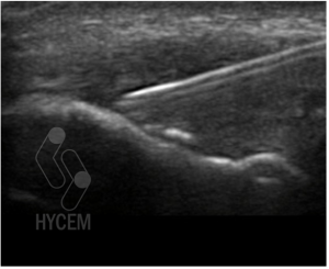 Ecografías de Hombro y Codo - HYCEM