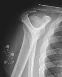 Radiografías de Hombro y Codo - HYCEM