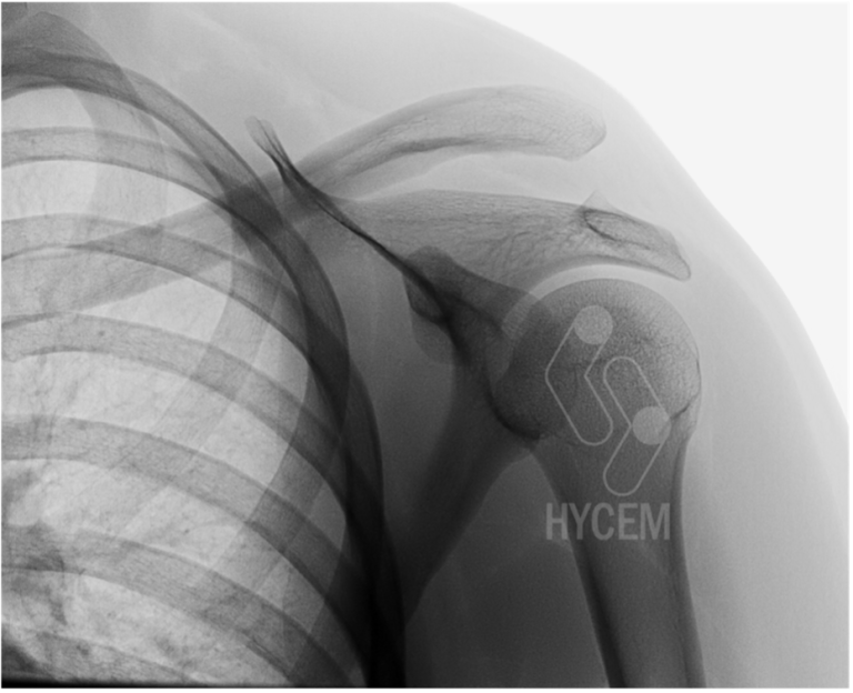 Luxación Acromiovlavicular - HYCEM